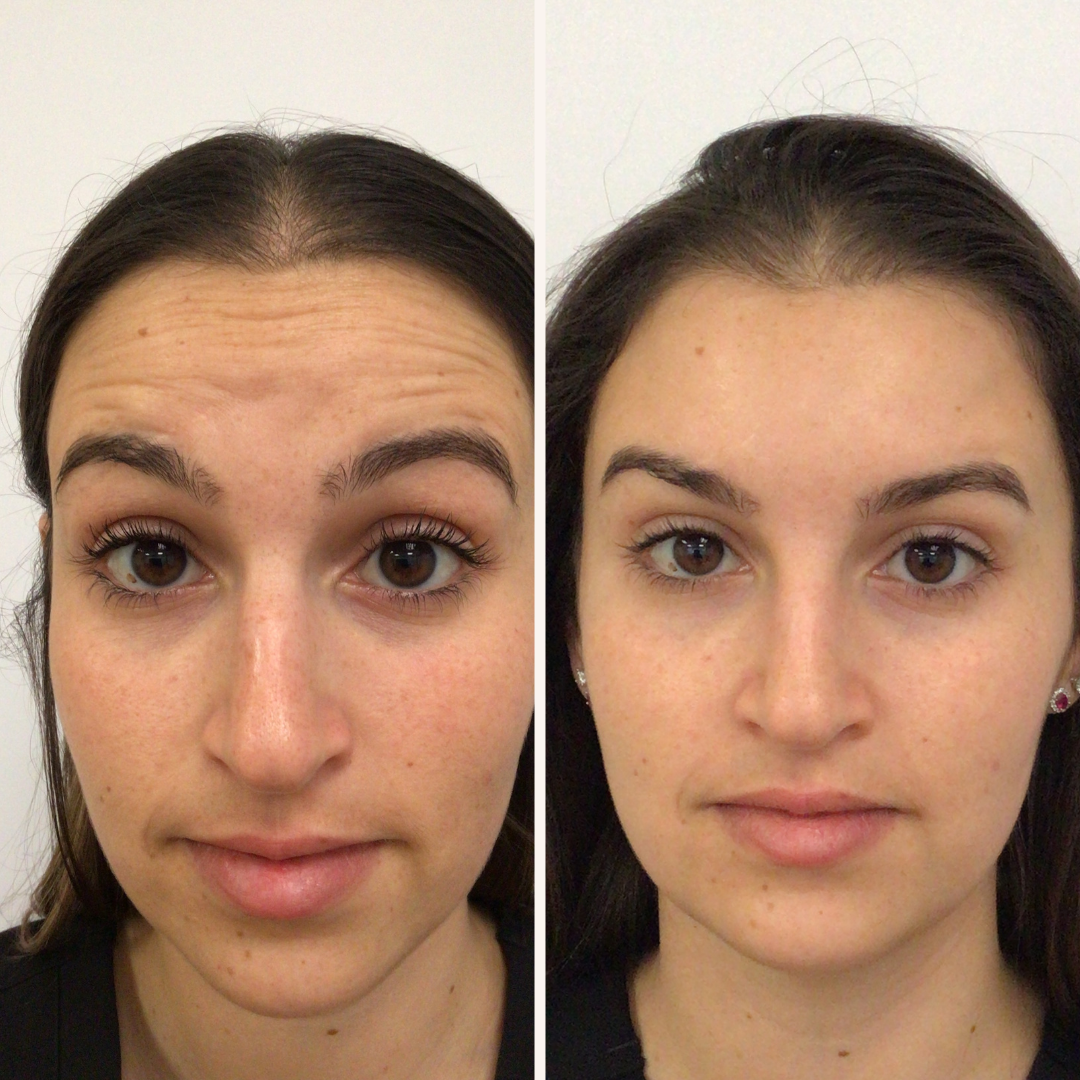 31-Year-Old Patient Receives 64 Units of Botox for Upper Face Wrinkles